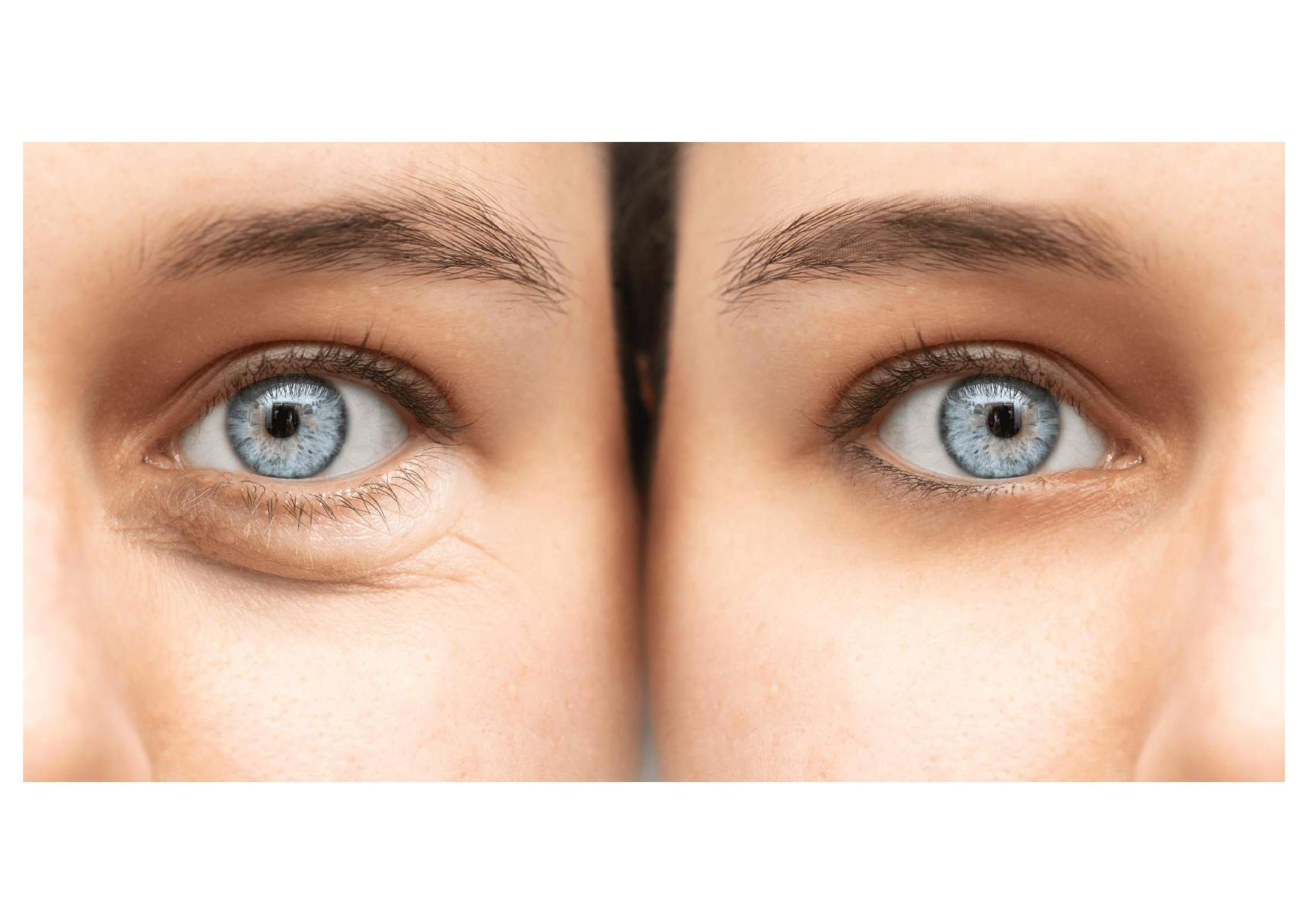 Apa Sih Perbedaan Kantung Mata dan Mata Panda? Cari Tau Cara Mengatasi ...